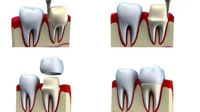 Do I Need a Crown or a Filling? | Dentist in Alpharetta GA